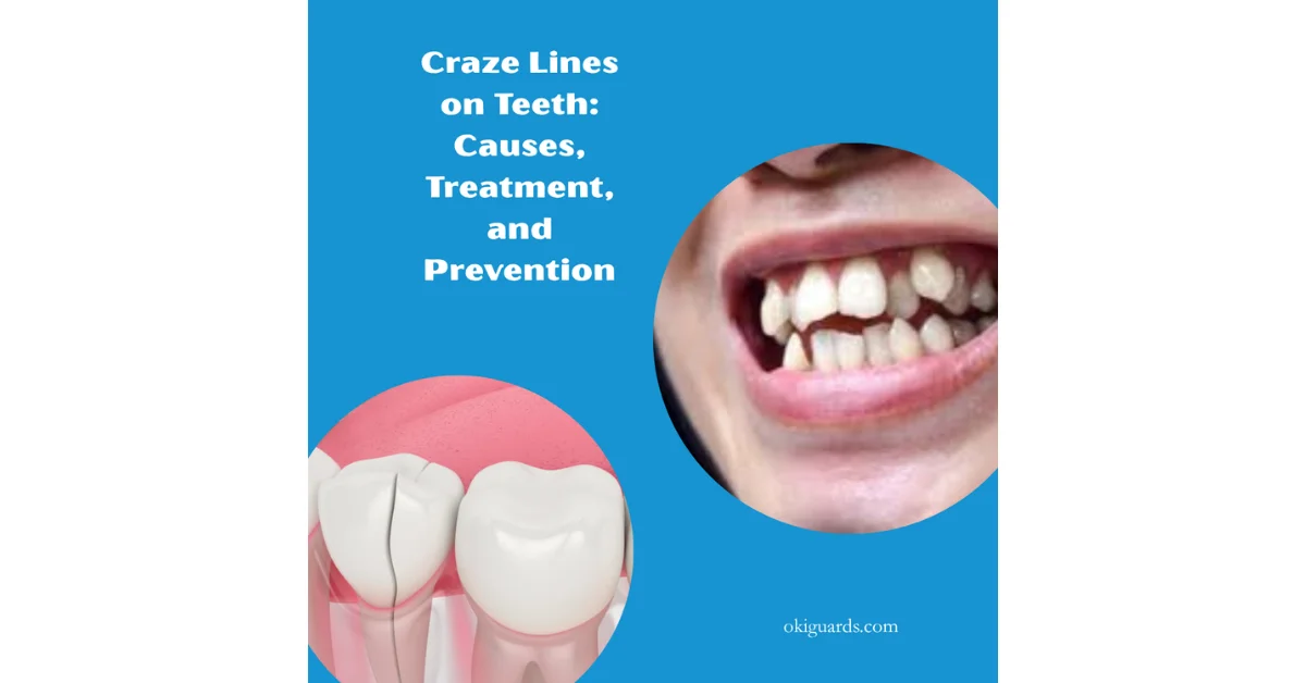 Craze Lines on Teeth: Causes, Treatment, and Prevention