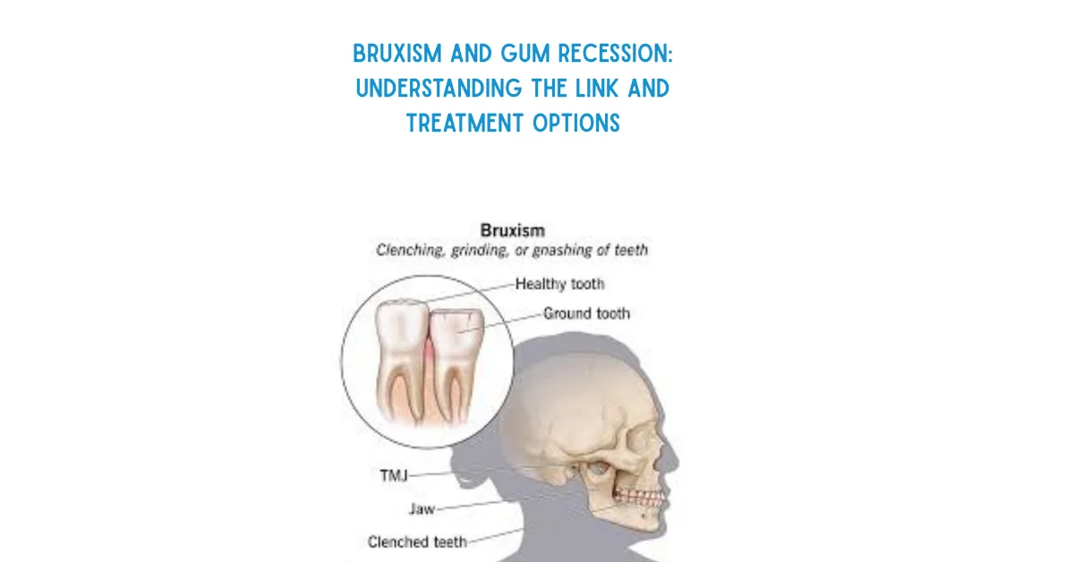 Bruxism and Gum Recession: Causes, Connection, and Treatment