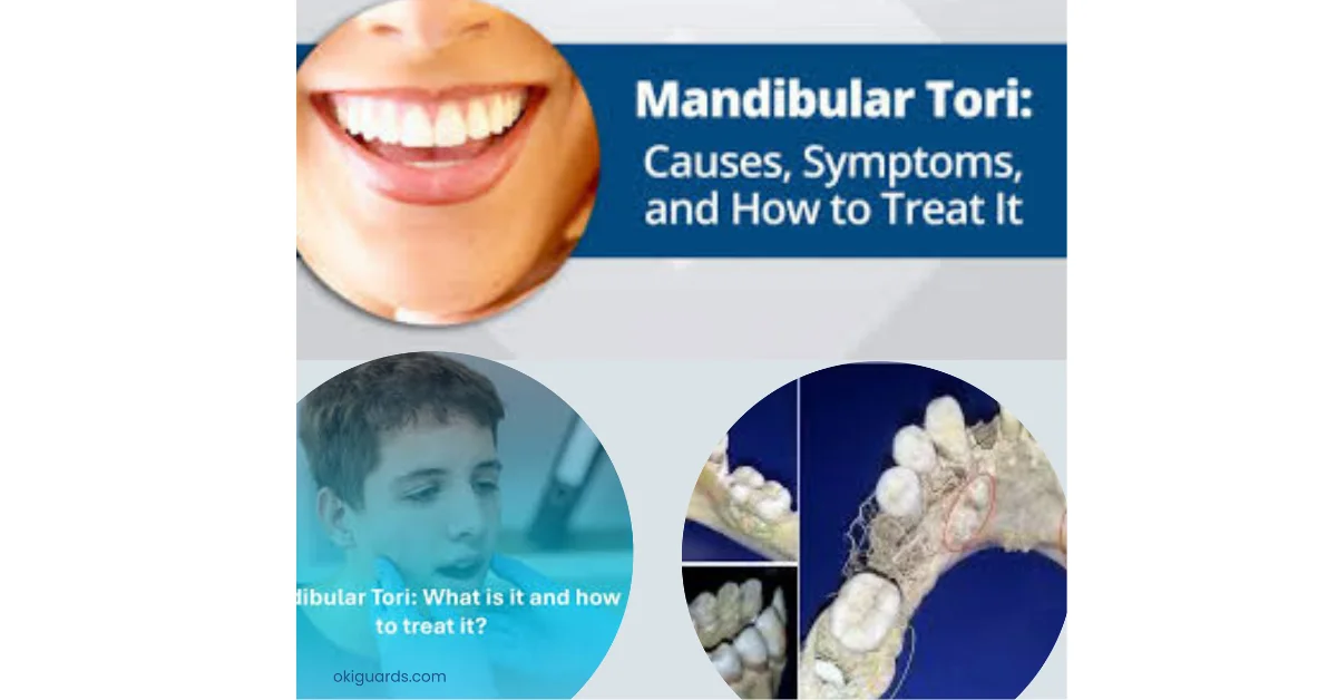 Mandibular Tori: Stages, Causes, and Treatment
